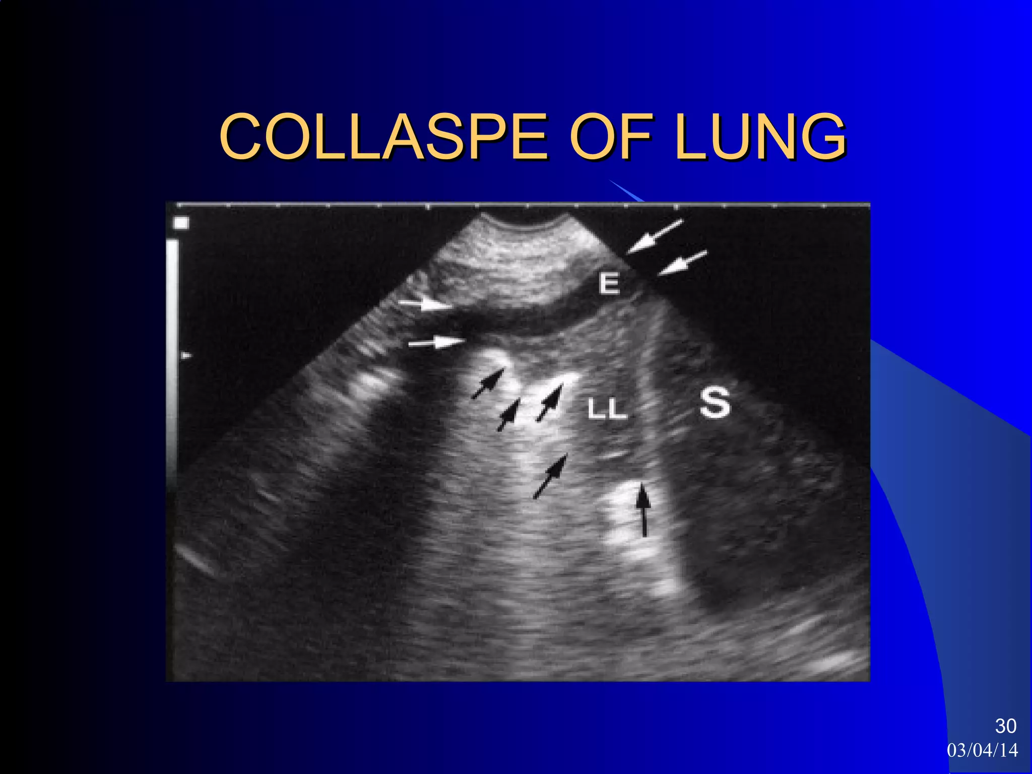 Chest ultrasound | PPT