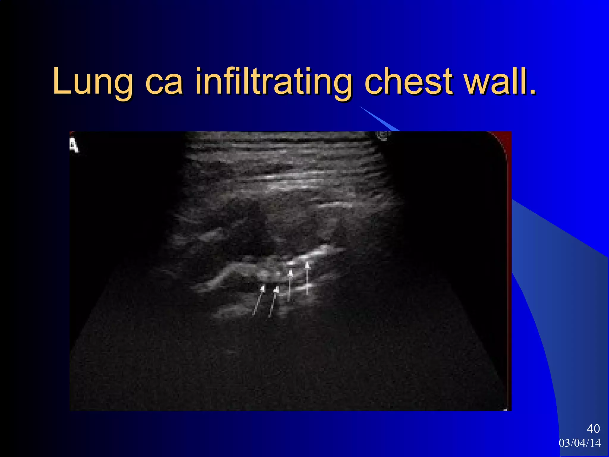 Chest ultrasound | PPT
