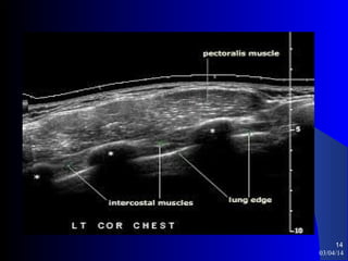 Chest ultrasound | PPT