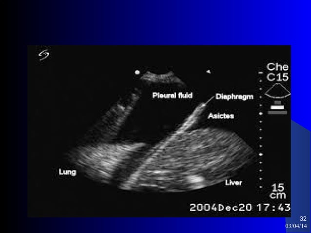 Chest ultrasound | PPT | Lung and Respiratory Health | Diseases and ...