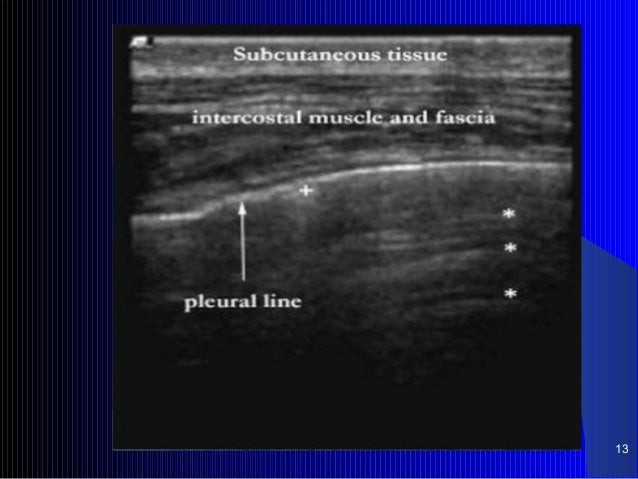 Chest ultrasound