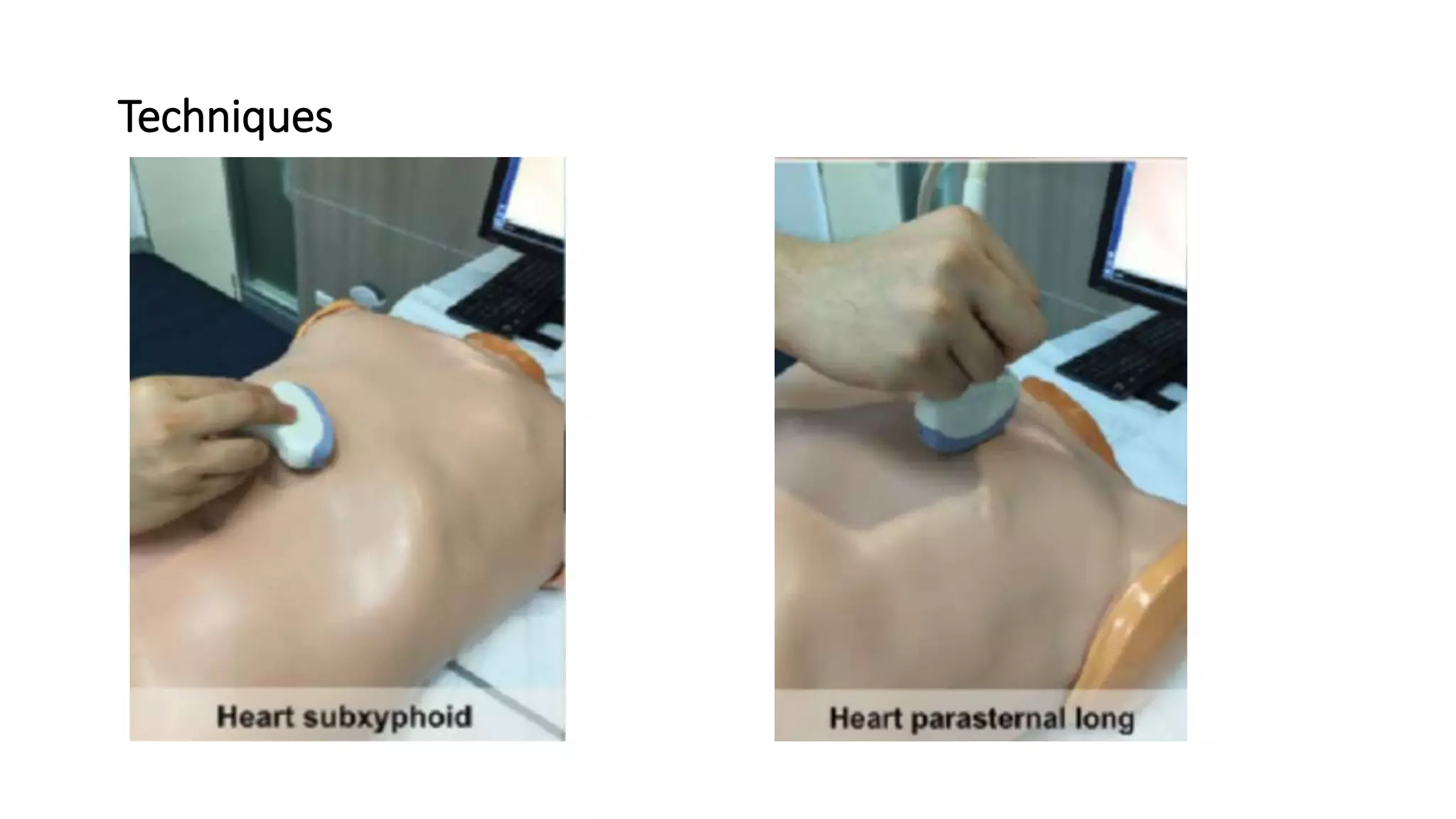 Chest ultrasound in emergency | PPTX