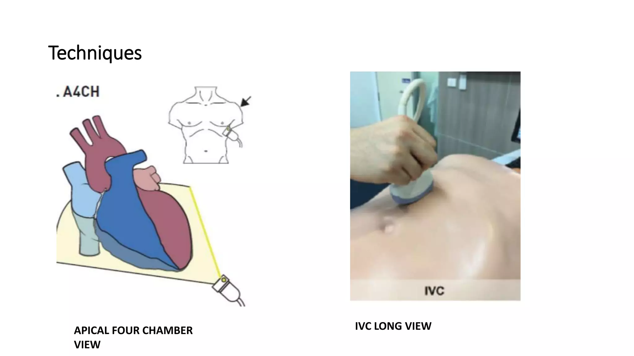 Chest ultrasound in emergency | PPTX