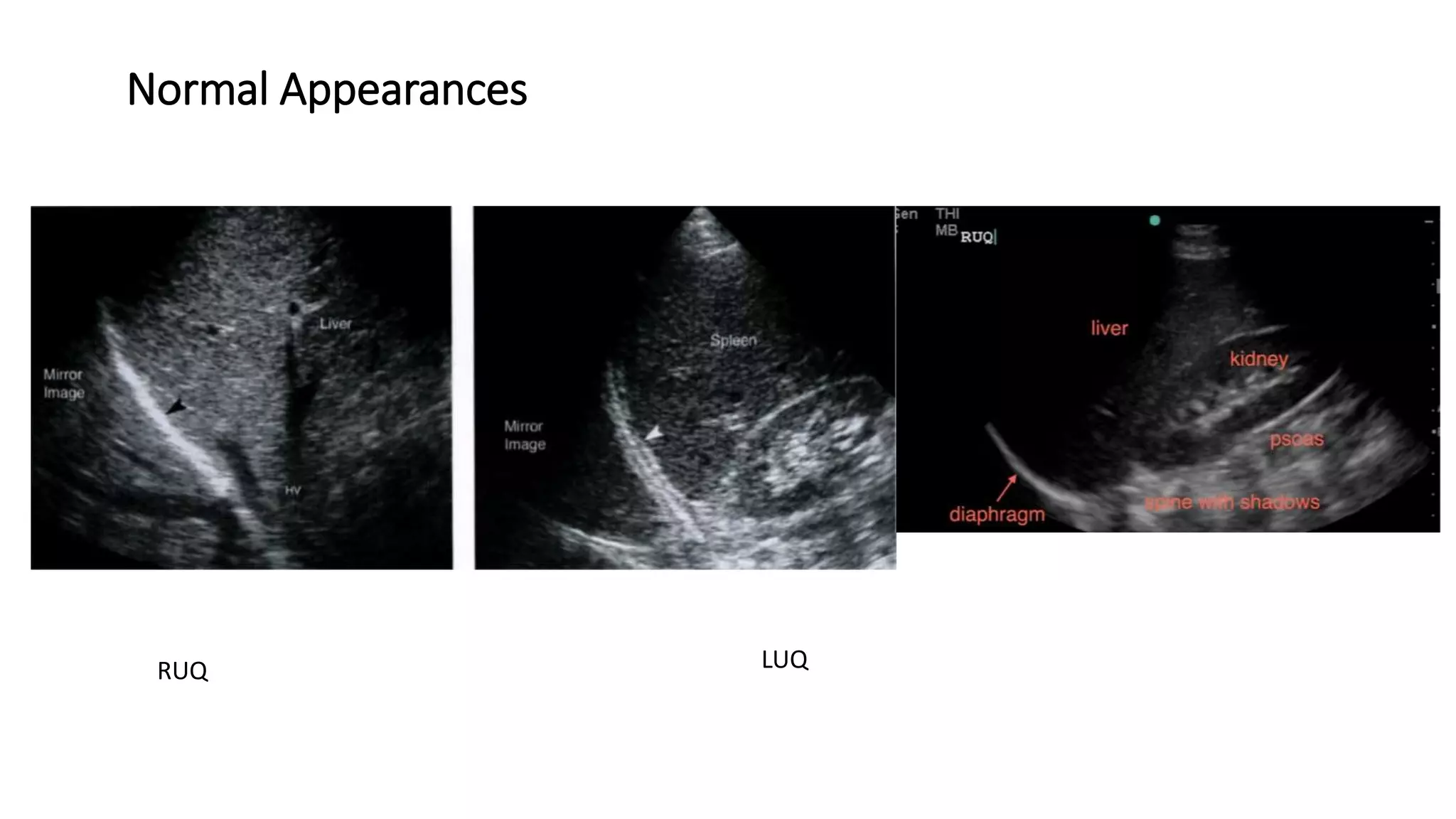 Chest ultrasound in emergency | PPTX