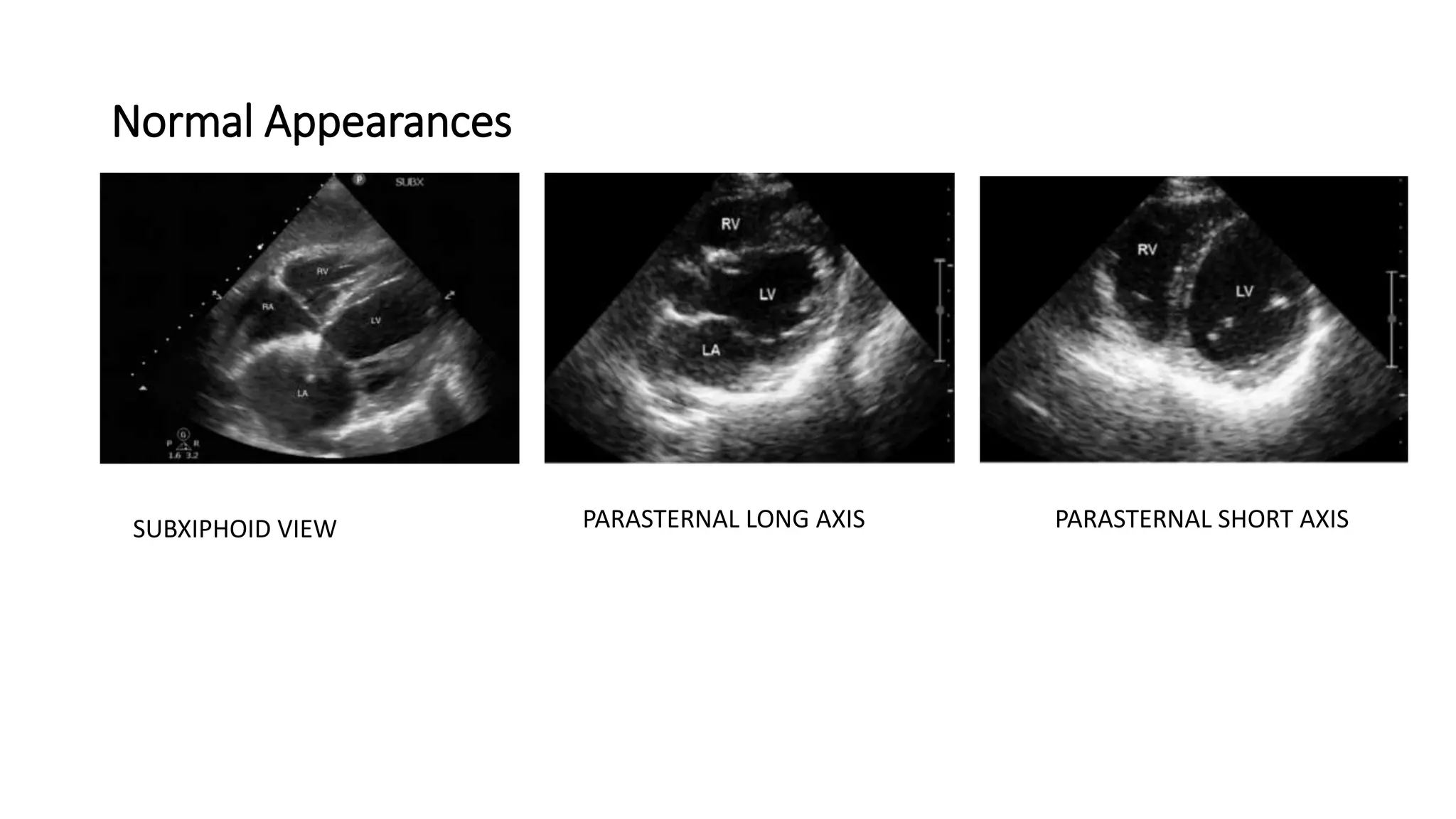 Chest ultrasound in emergency | PPTX