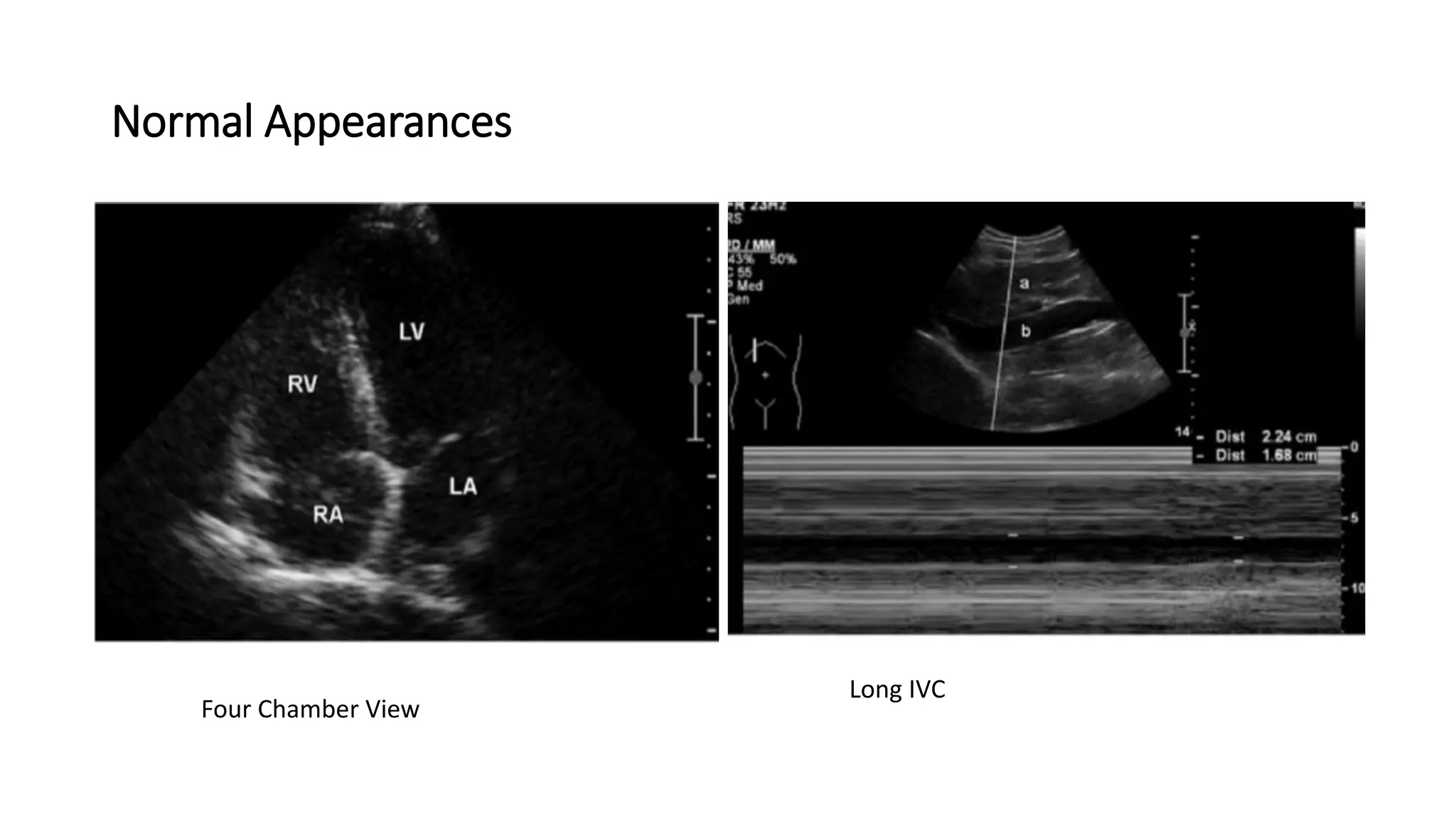Chest ultrasound in emergency | PPTX