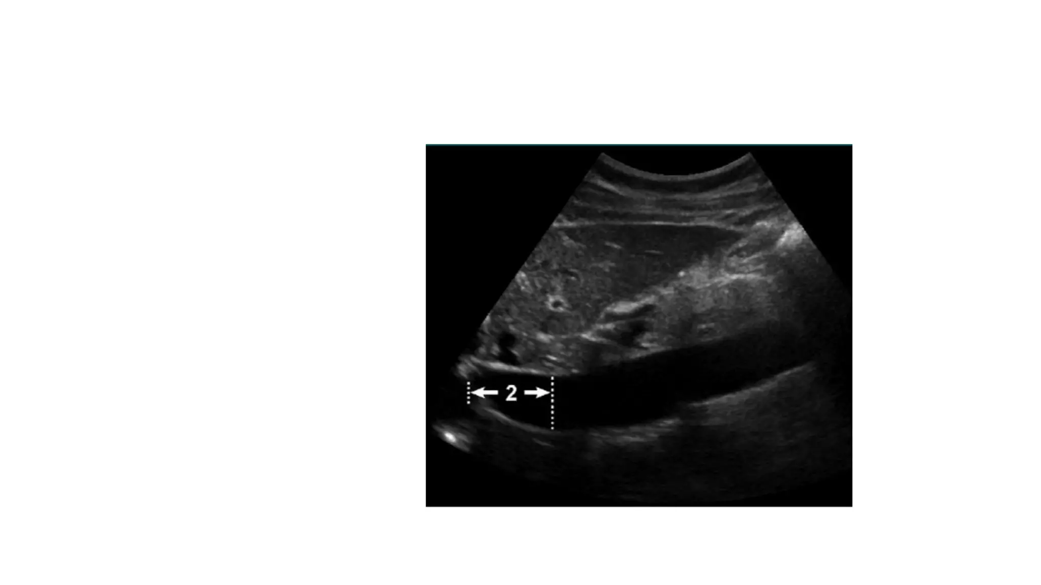 Chest ultrasound in emergency | PPTX