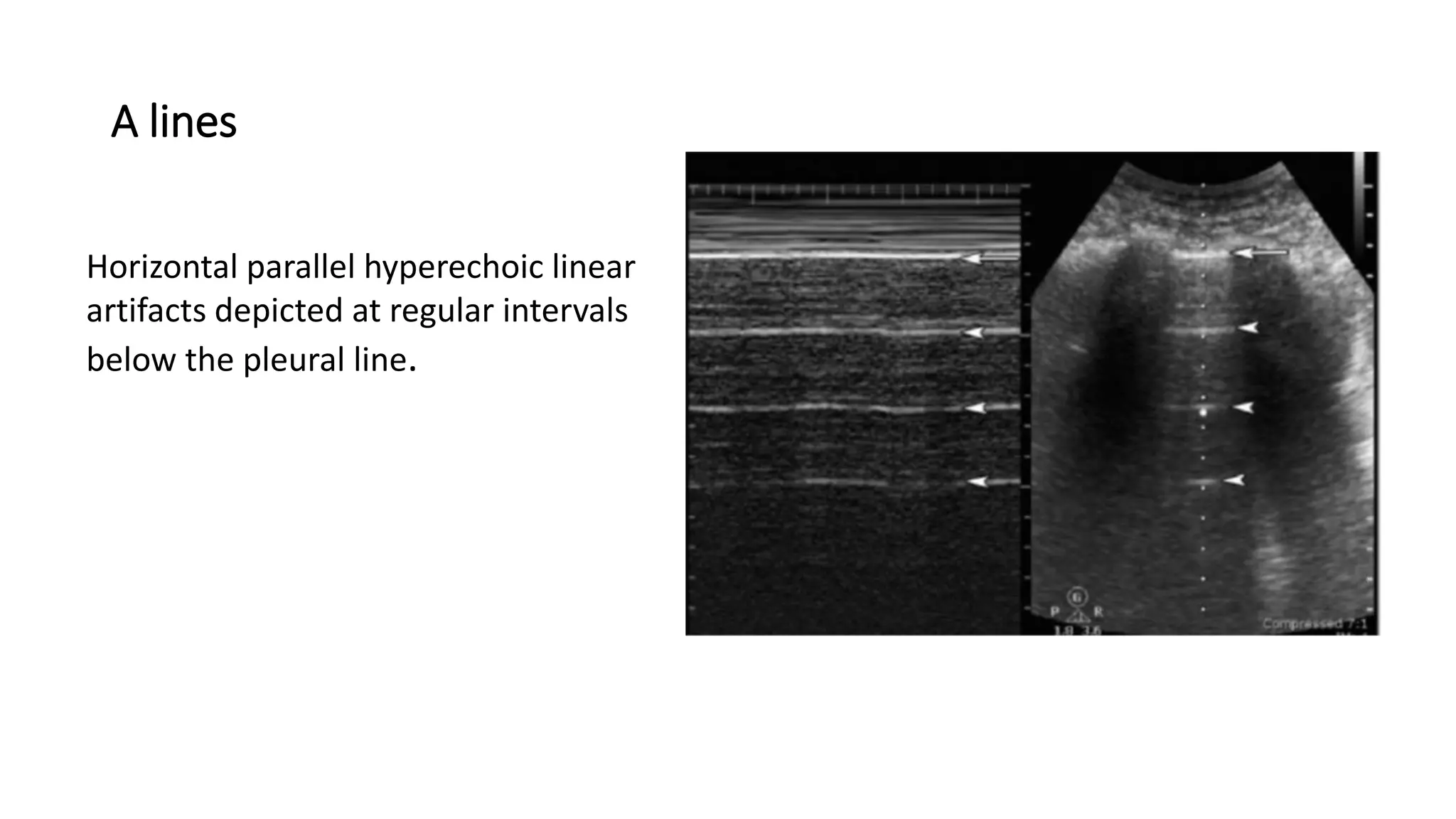 Chest ultrasound in emergency | PPTX