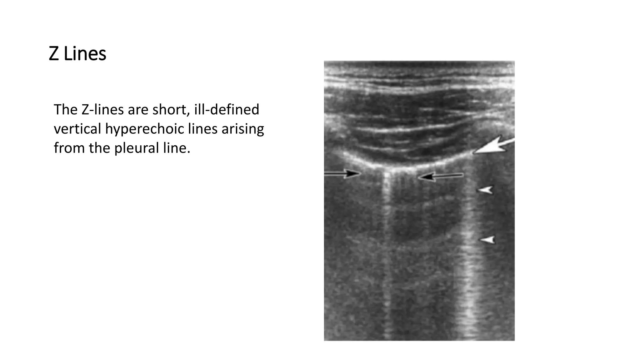 Chest ultrasound in emergency | PPTX