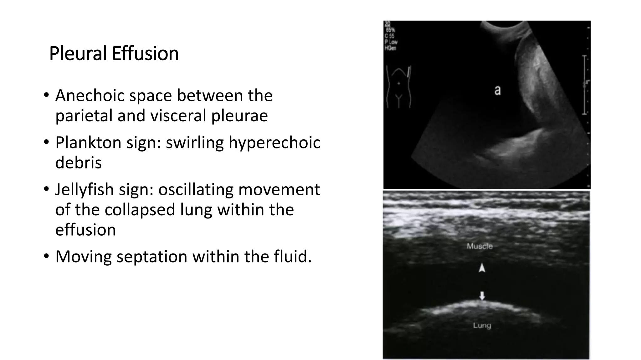 Chest ultrasound in emergency | PPTX