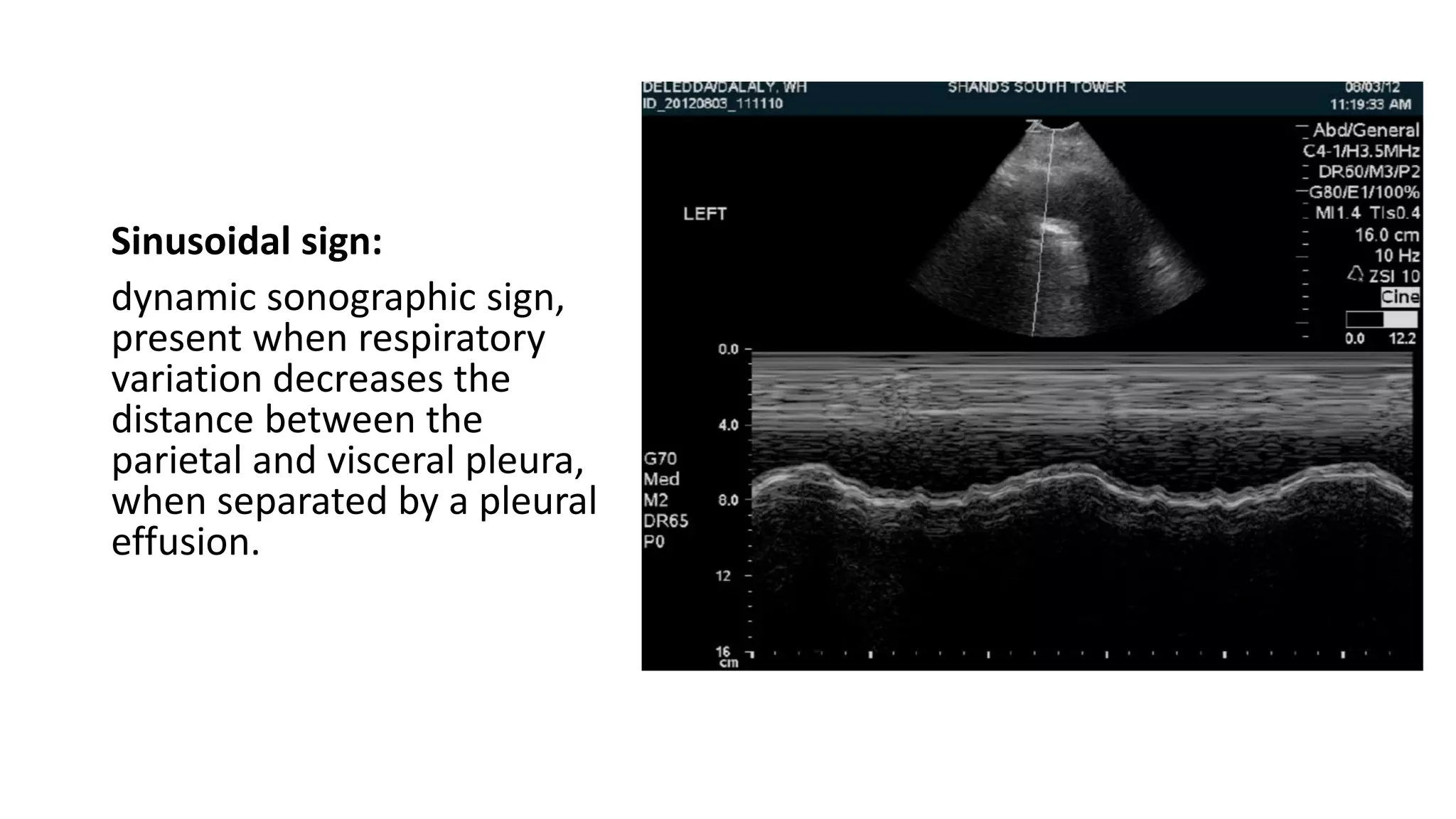 Chest ultrasound in emergency | PPTX