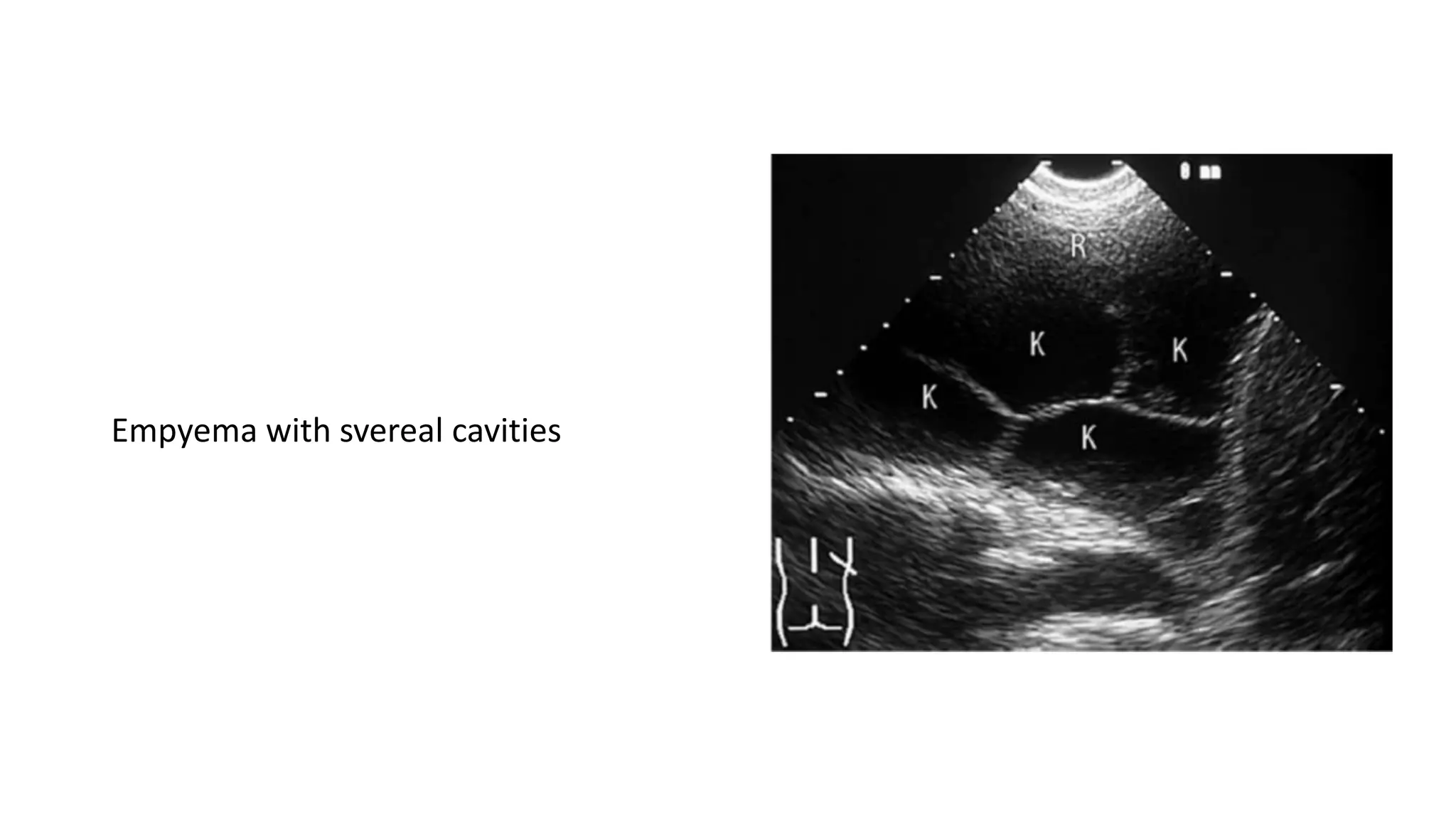 Chest ultrasound in emergency | PPTX
