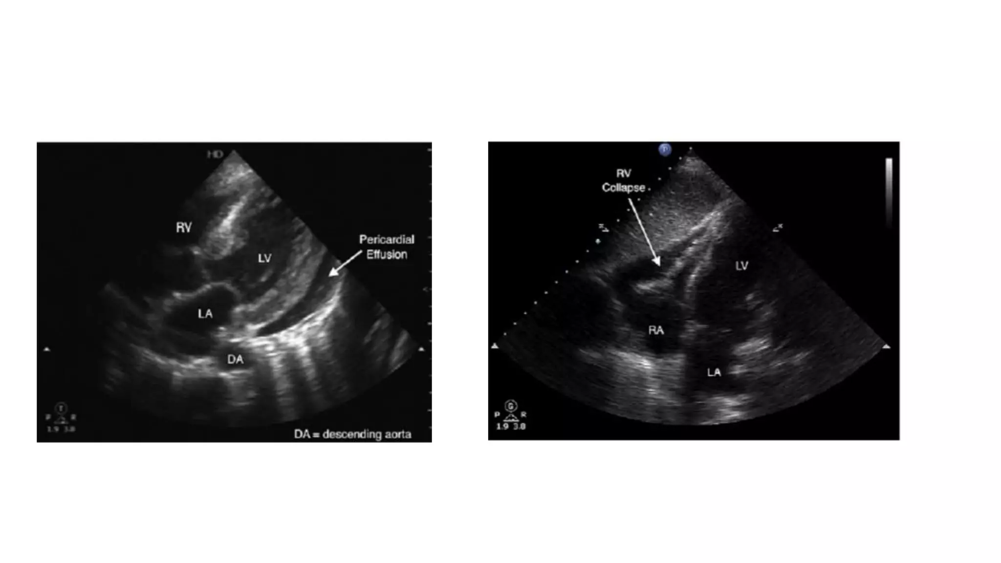 Chest ultrasound in emergency | PPTX