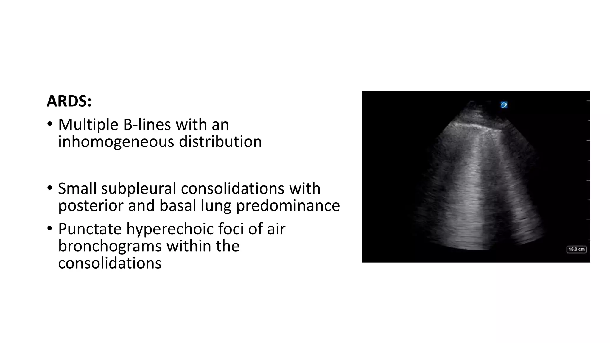 Chest ultrasound in emergency | PPTX