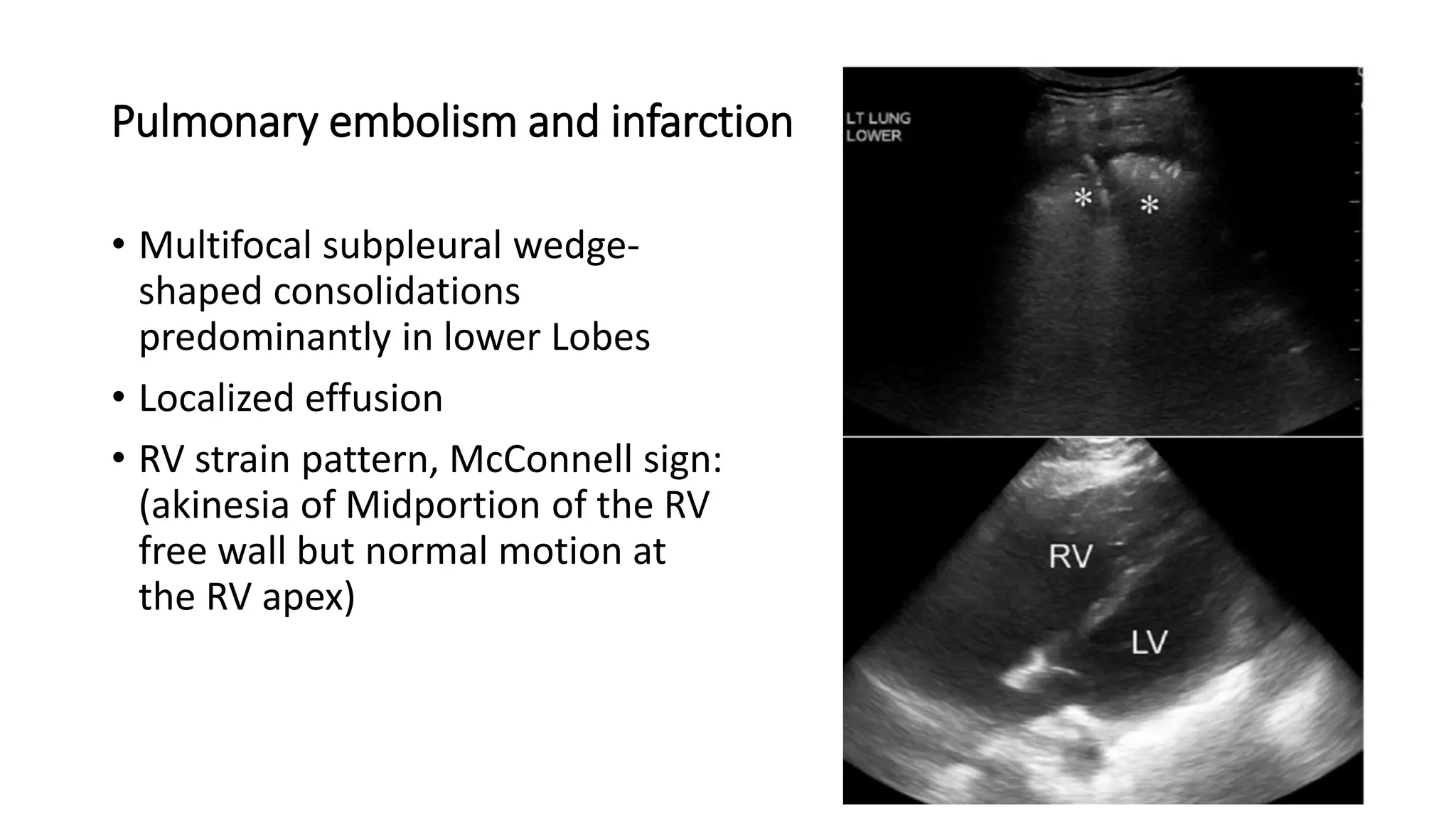 Chest ultrasound in emergency | PPTX