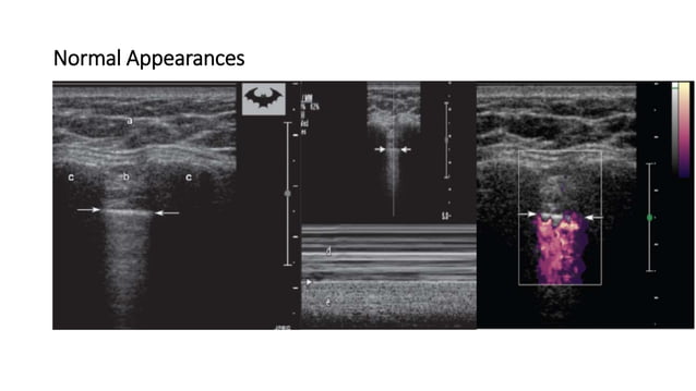 Chest ultrasound in emergency | PPTX | Lung and Respiratory Health ...