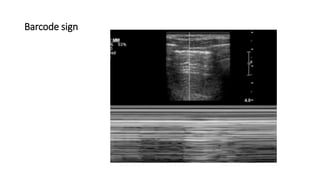 Chest ultrasound in emergency | PPTX