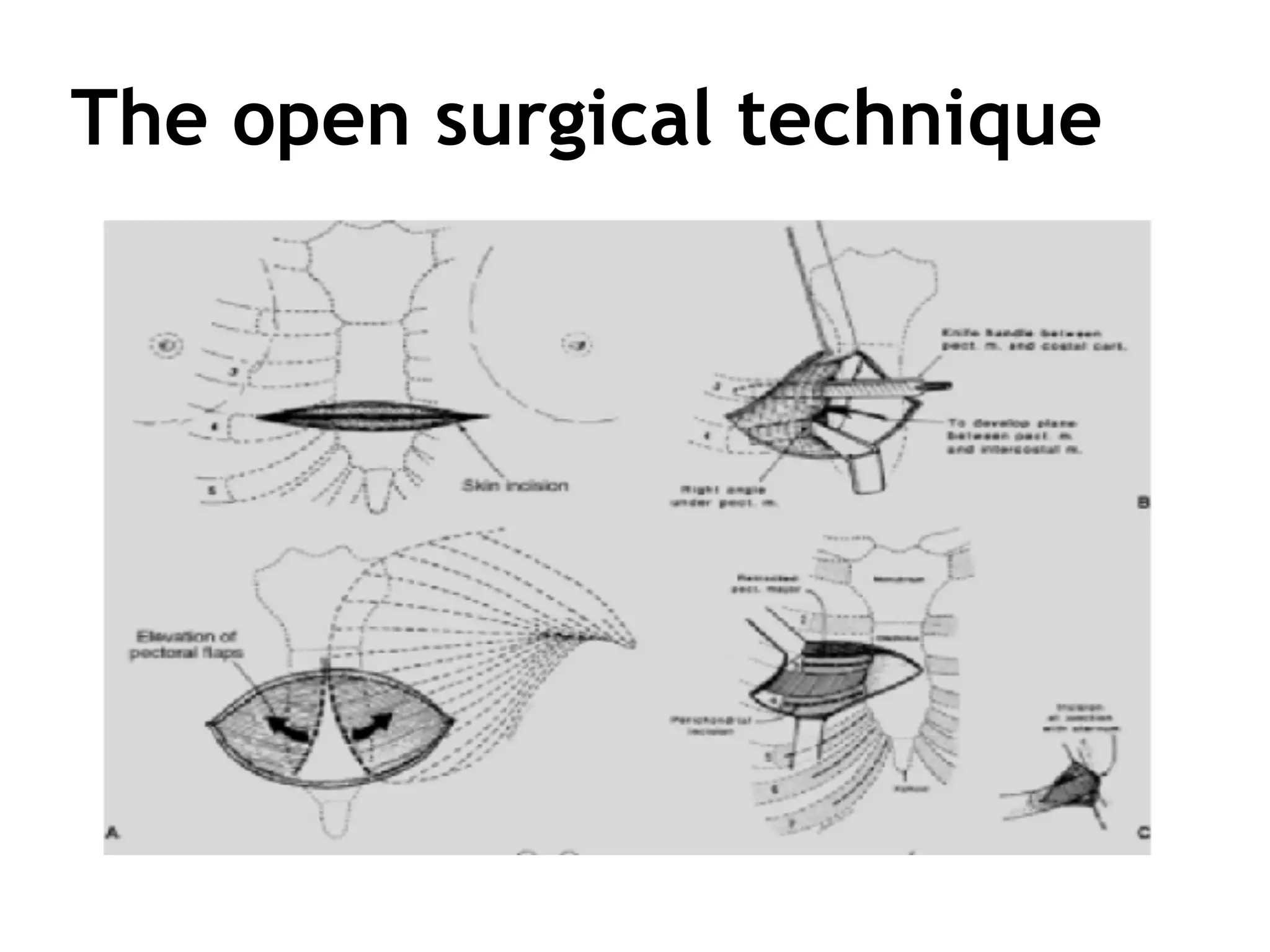 Chest wall deformities | PDF