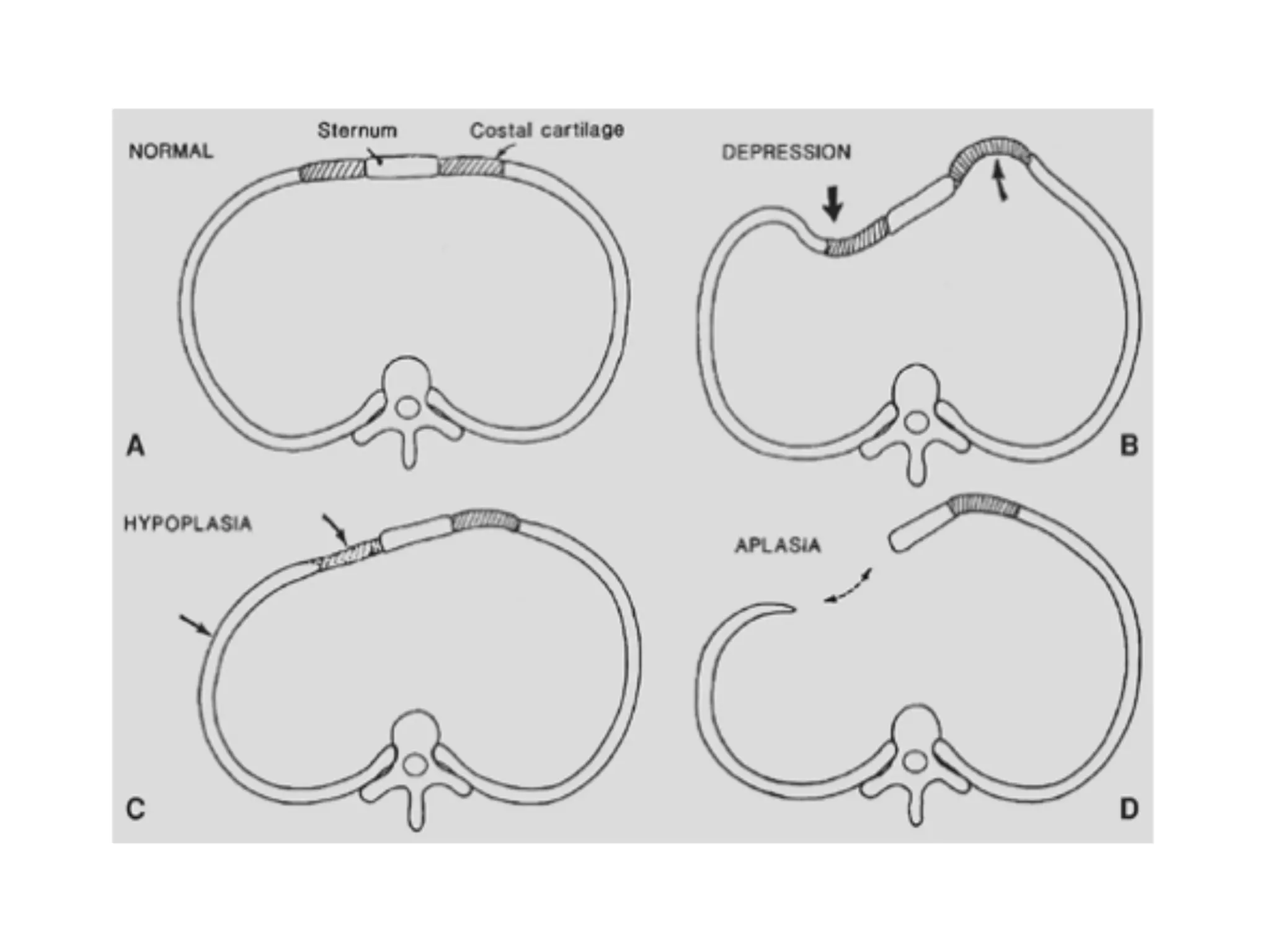 Chest wall deformities | PDF