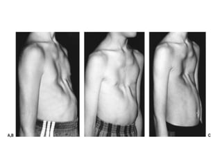 Chest wall deformities | PDF
