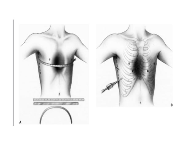 Chest wall deformities | PDF