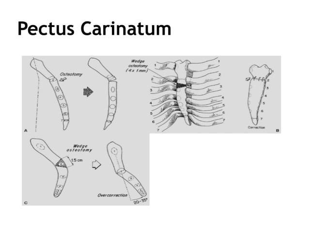 Chest wall deformities | PDF