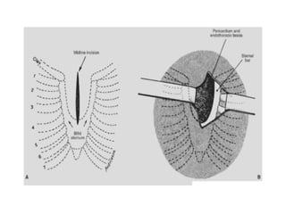 Chest wall deformities | PDF