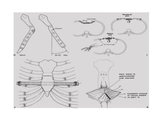 Chest wall deformities | PPT