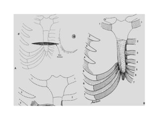 Chest wall deformities | PPT