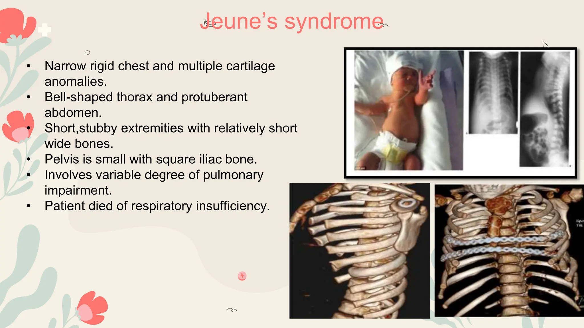 chest wall deformities ( pectus excavatum, pectus carinatum etc.) | PPTX