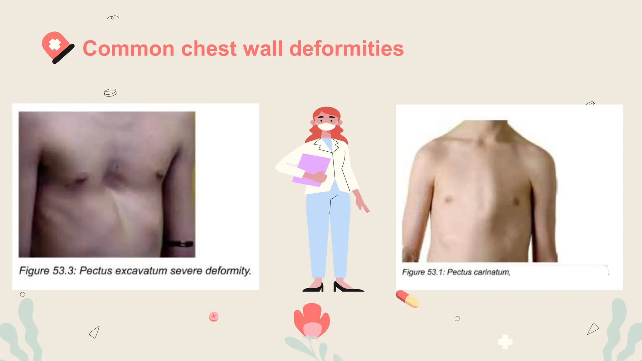 chest wall deformities ( pectus excavatum, pectus carinatum etc.) | PPTX
