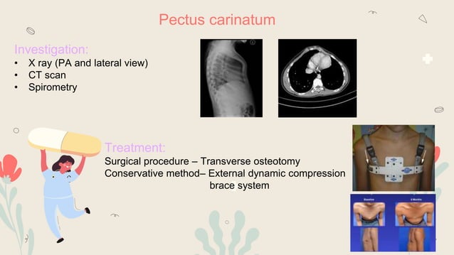 chest wall deformities ( pectus excavatum, pectus carinatum etc.) | PPTX