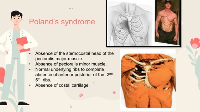 chest wall deformities ( pectus excavatum, pectus carinatum etc.) | PPTX