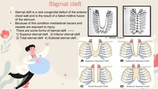 chest wall deformities ( pectus excavatum, pectus carinatum etc.) | PPTX