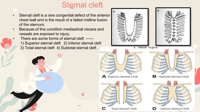 chest wall deformities ( pectus excavatum, pectus carinatum etc.) | PPTX