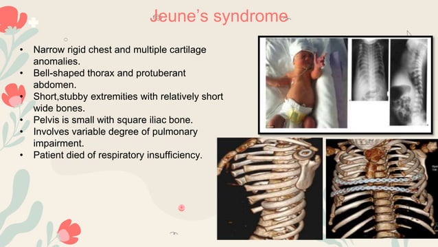 chest wall deformities ( pectus excavatum, pectus carinatum etc.) | PPTX