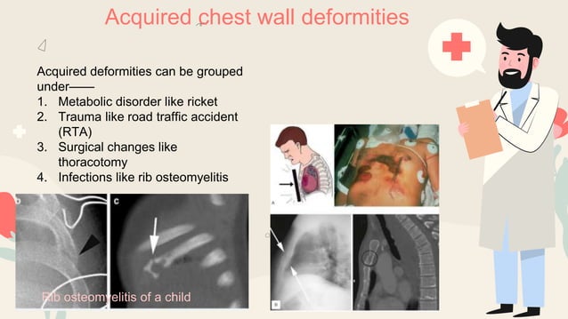 chest wall deformities ( pectus excavatum, pectus carinatum etc.) | PPTX