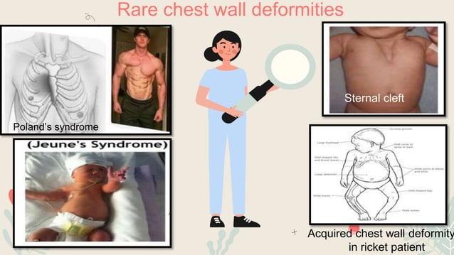chest wall deformities ( pectus excavatum, pectus carinatum etc.) | PPTX