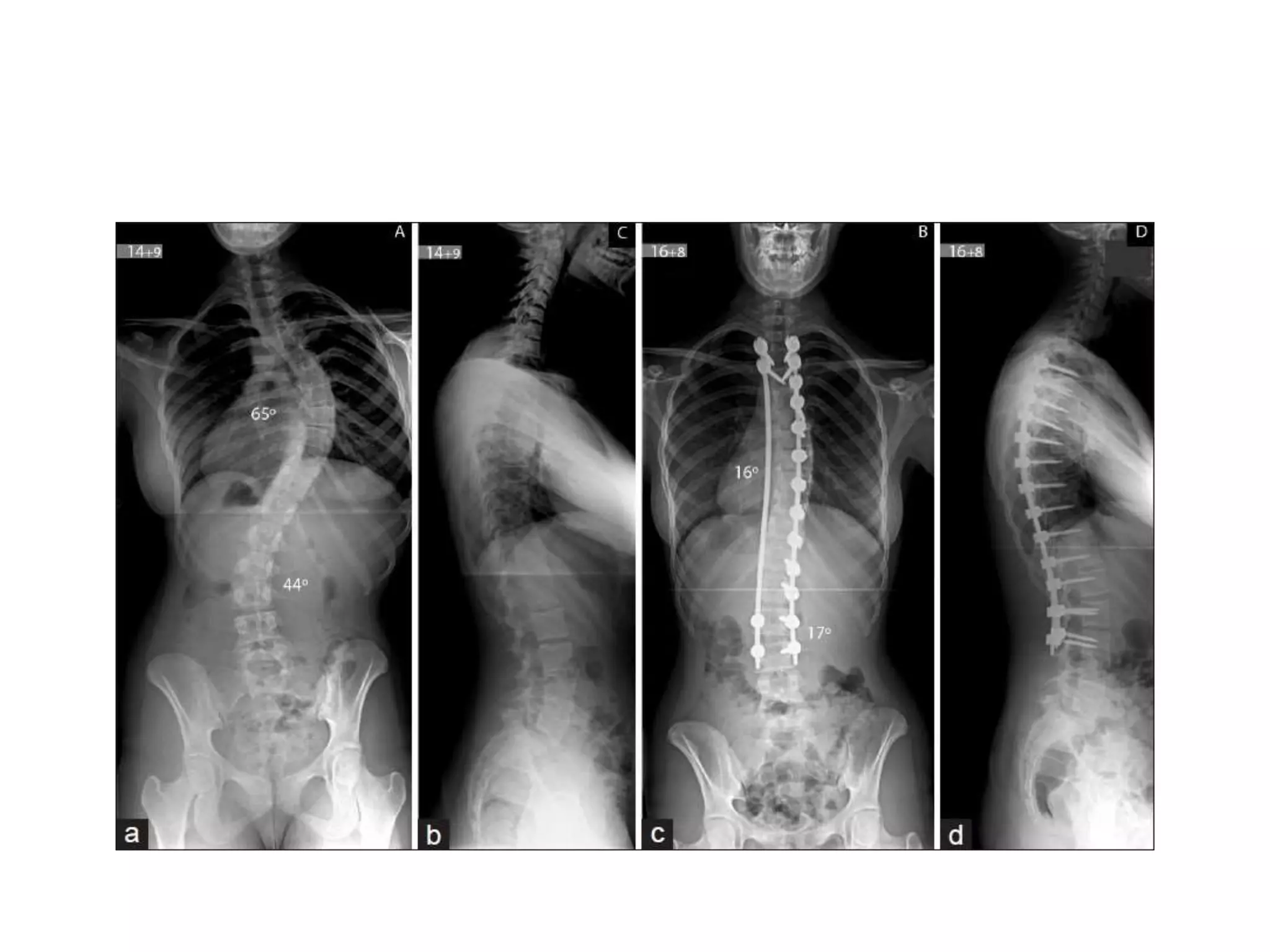 Chest Wall Deformity | PPTX