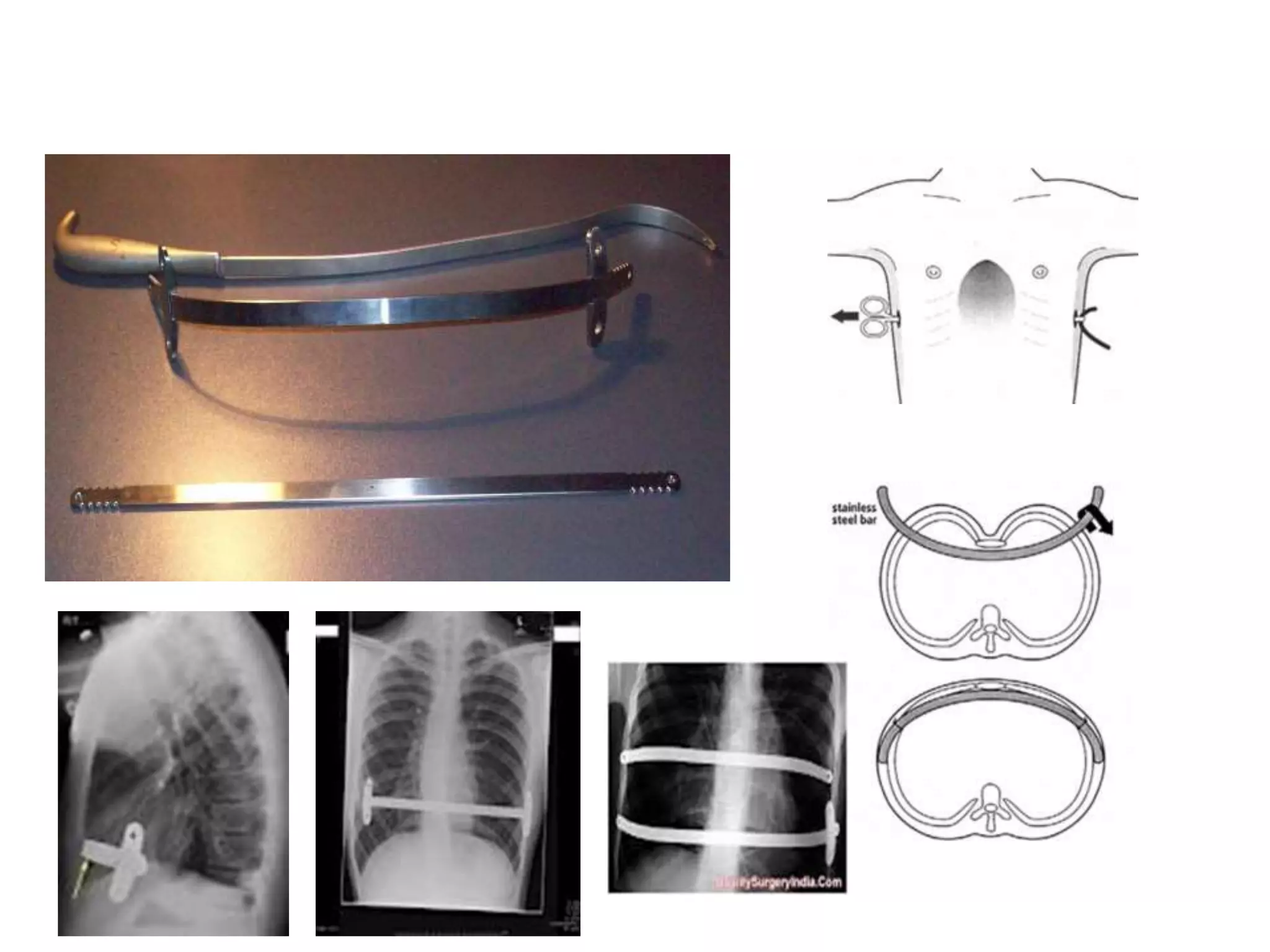 Chest Wall Deformity | PPTX