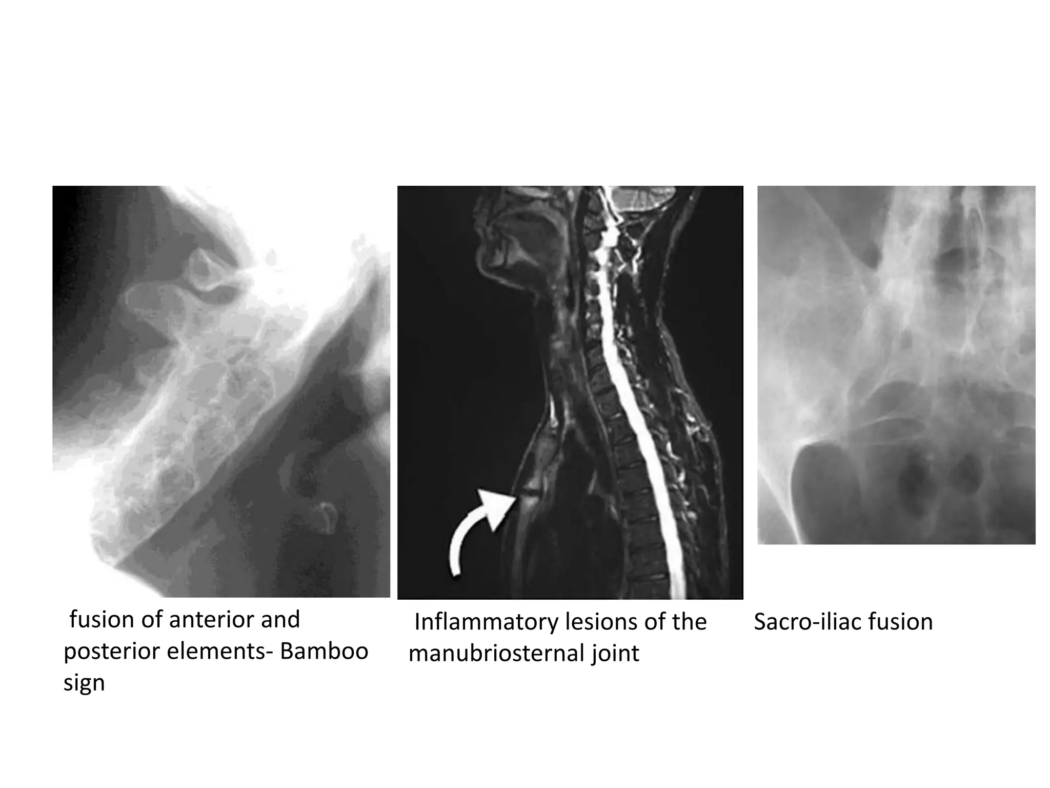 Chest Wall Deformity | PPTX