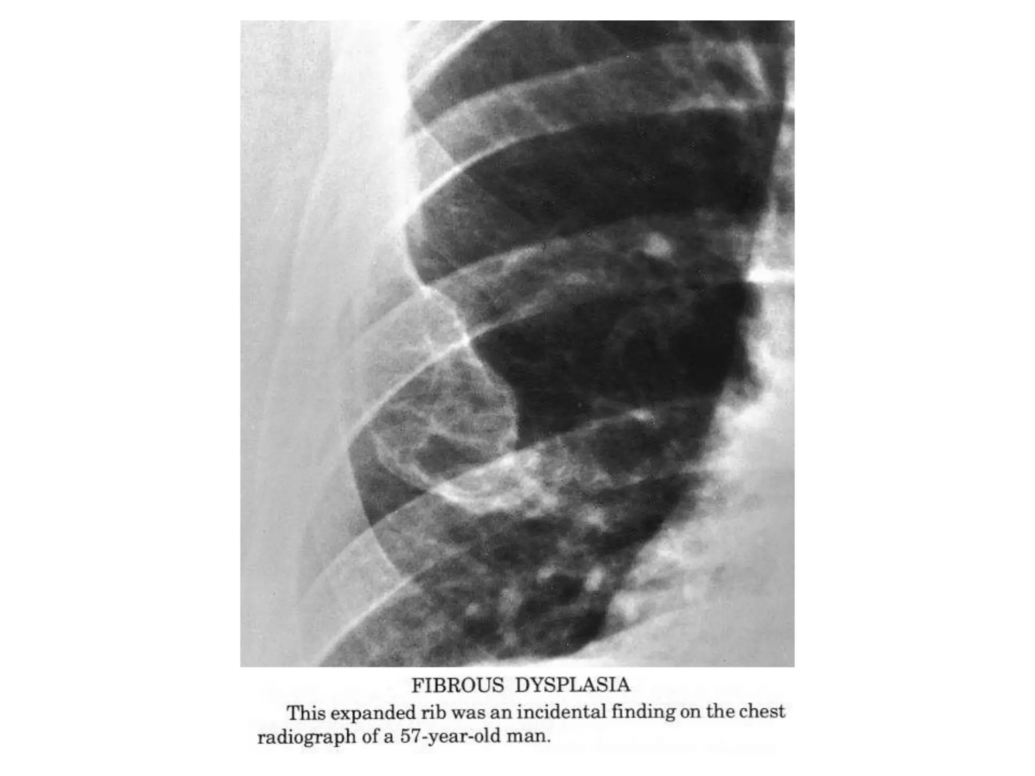 Chest Wall Deformity | PPTX