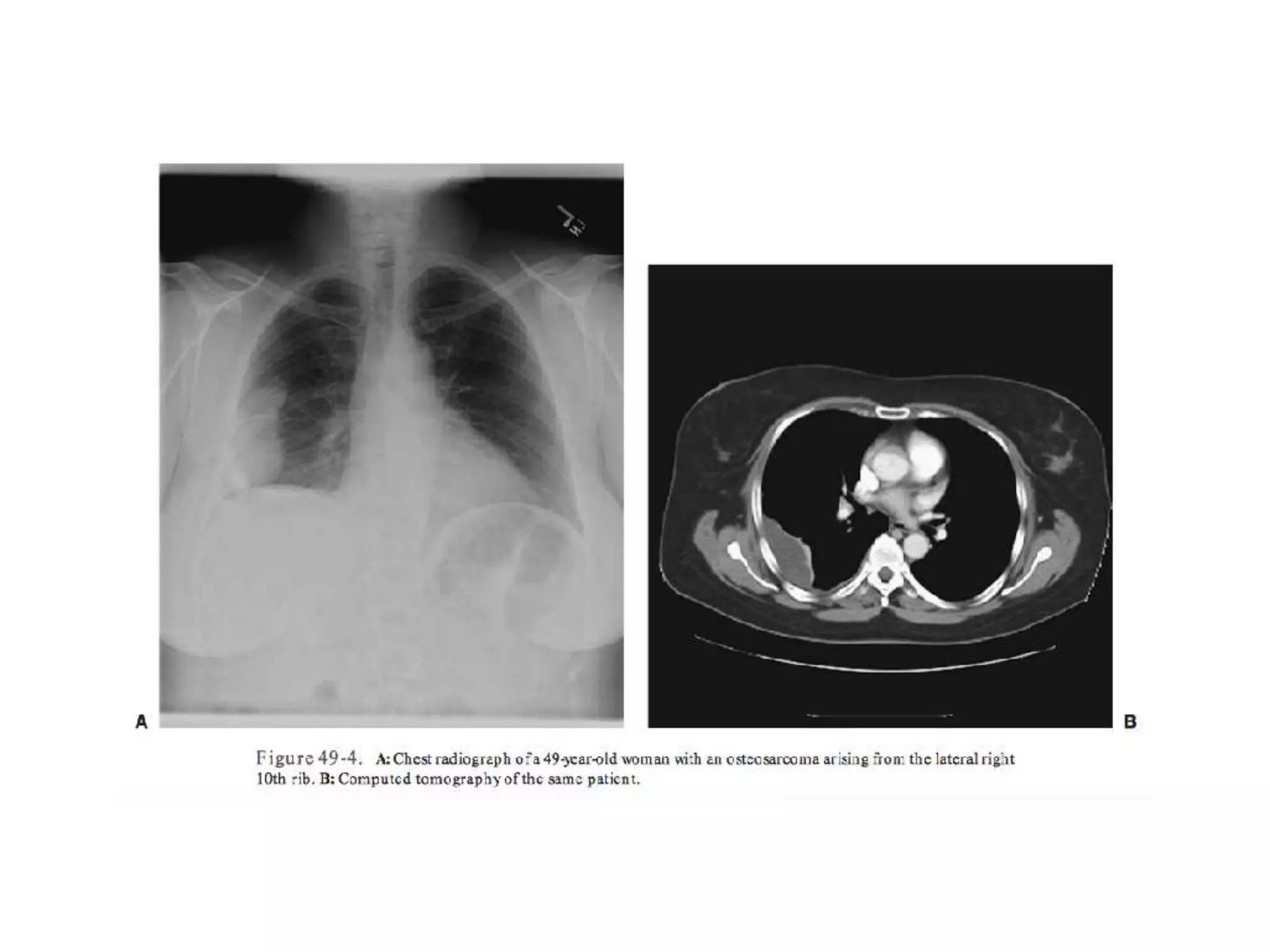 Chest Wall Deformity | PPTX