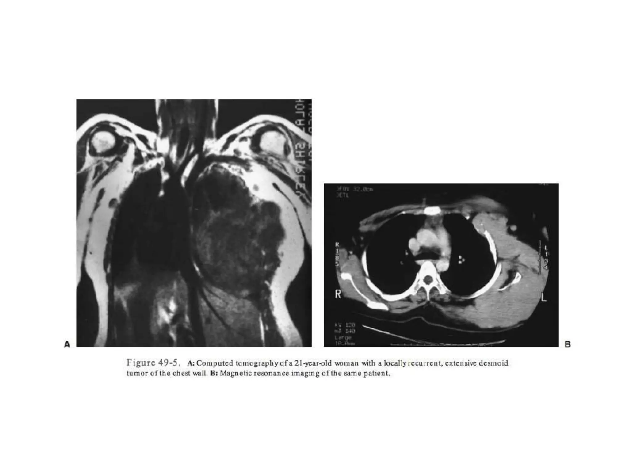 Chest Wall Deformity | PPTX