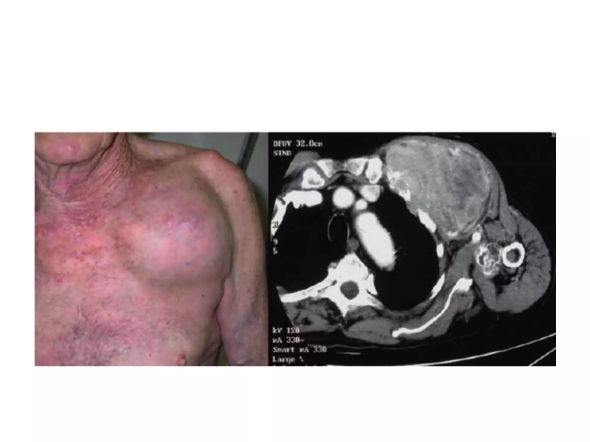 Chest Wall Deformity | PPTX