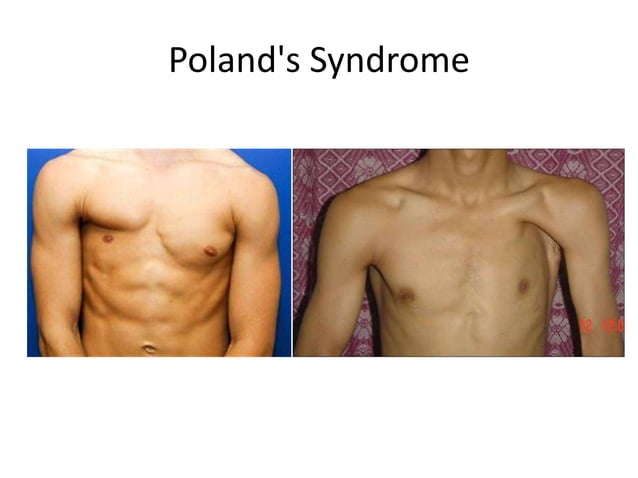 Chest Wall Deformity