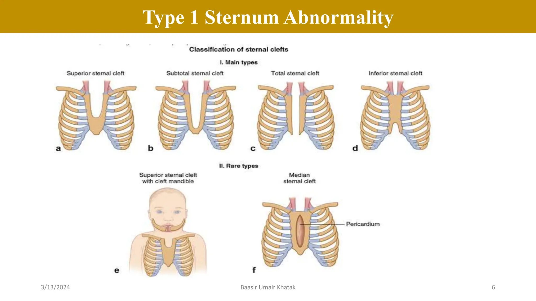 Chest wall deformity by Baasir Umair Khatak.pptx