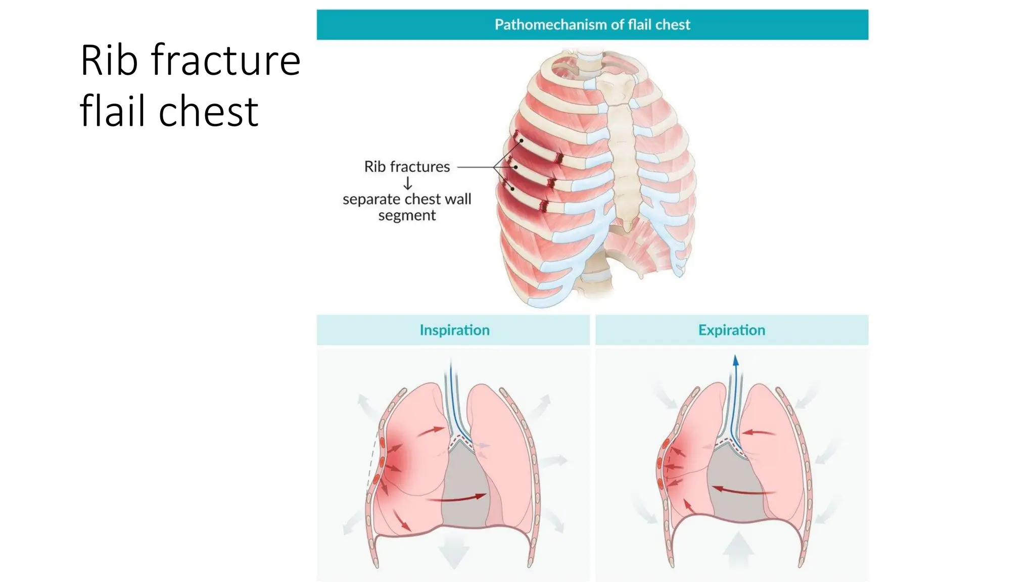 Chest Wall Surgery, Indications, Diagnosis, Management | PDF