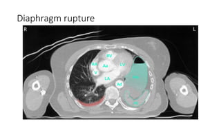 Chest Wall Surgery, Indications, Diagnosis, Management | PPT