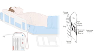 Chest Wall Surgery, Indications, Diagnosis, Management | PPT